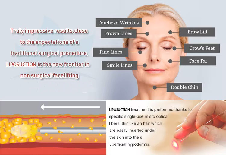 Laser Endolifting Dual 39W – TecnoEsteticos.com